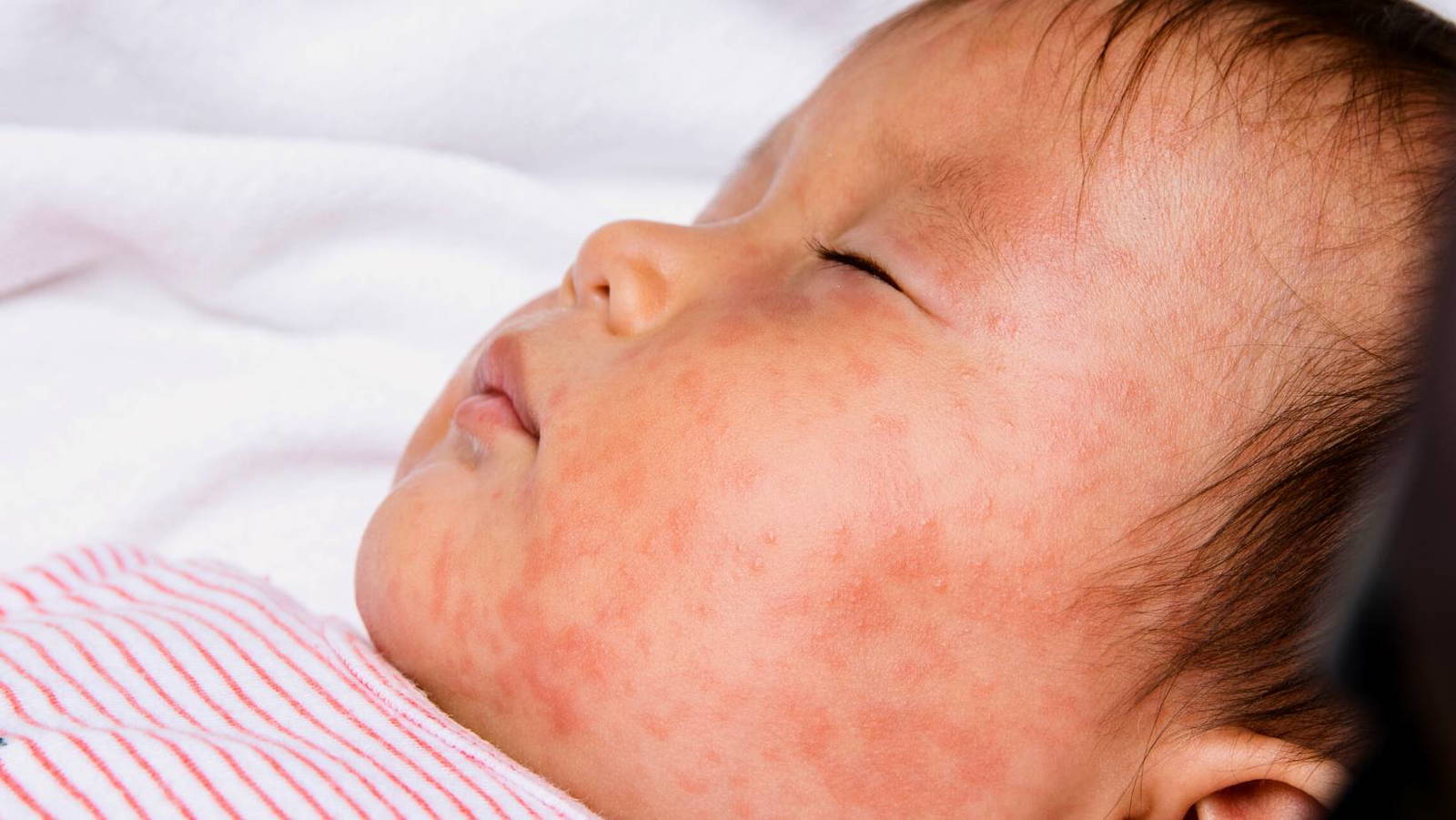 Kenali Bintik Merah Pada Wajah Bayi, Ini 8 Penyebabnya!