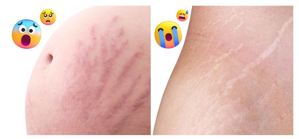 Pregnancy Stretch Marks: Red and White Stretch Marks