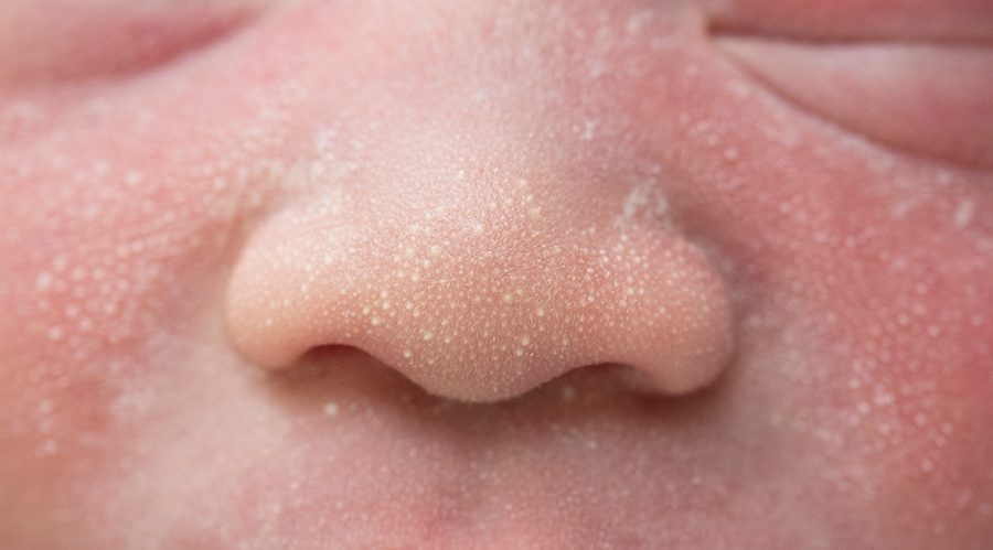 Baby Milia Treatment: 3 Safe Tips Paano Ito Matatanggal