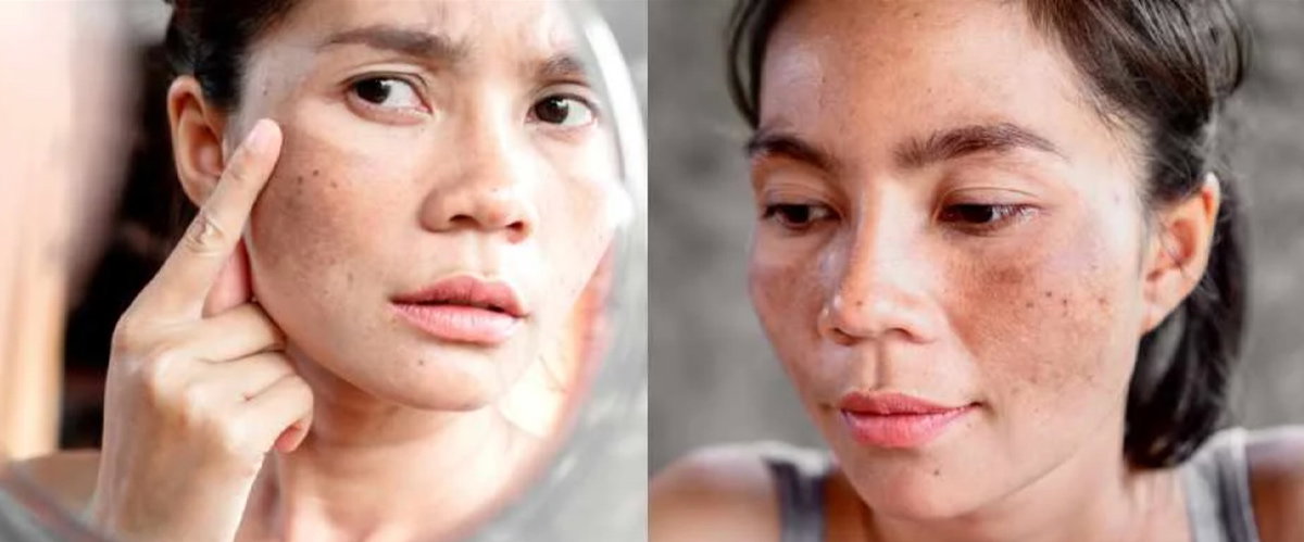 What is Melasma in Pregnancy and What You Can Do About It - Mama's ...