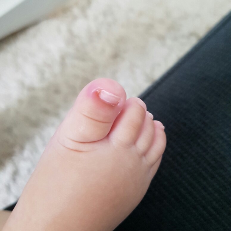 My 3 months 2 weeks old son has a infected toe and it seem