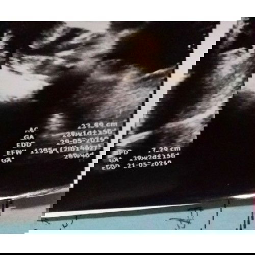 cara baca hasil USG bund.. mau tanya itu maksudnya apa ya