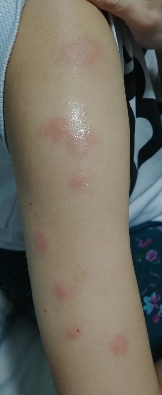 Hives / rash Hi, can i know is it normal to develop hives or