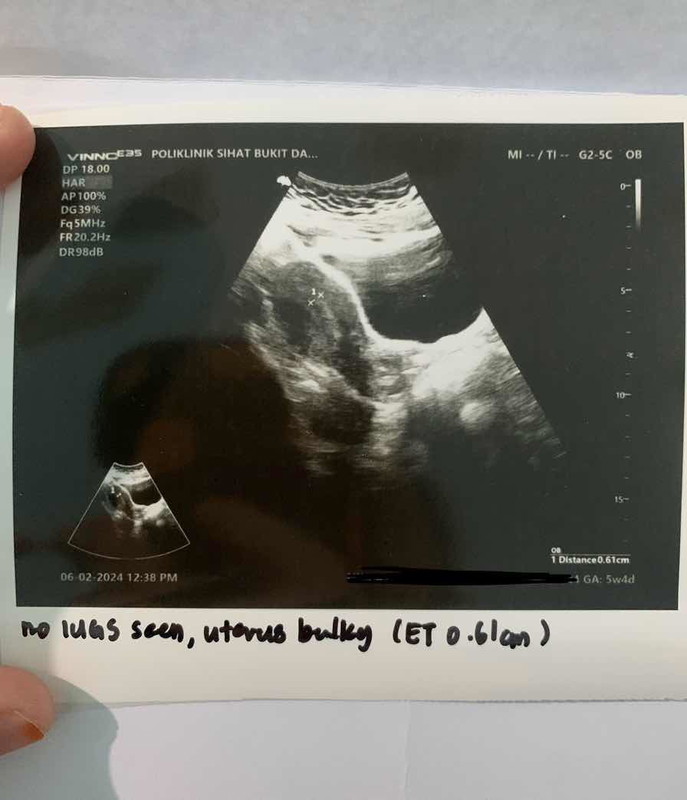 Ultrasound scan berapa minggu yang accurate? Assalamualaikum