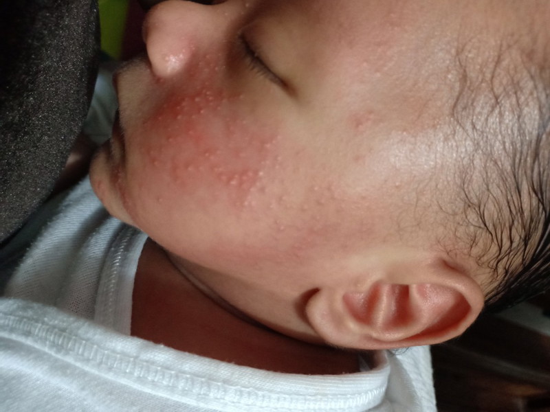 Rashes Rashes po ni baby sa face, both cheeks po meron. Ano