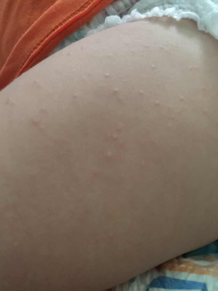 Butlig sa paa ni lo Mga mommies ano po eto sa legs ni baby?