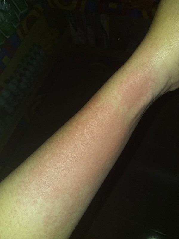 Rashes ano po ba gamot para sa rashes ? may mga Rashes kasi