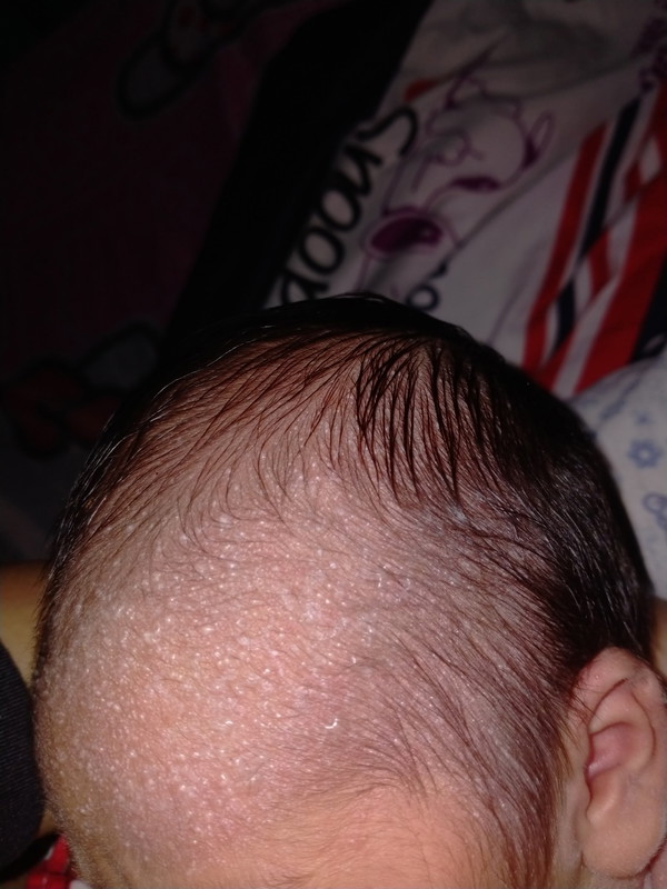 butlig sa ulo ni baby Mga mamsh sana po may makasagot, ano p