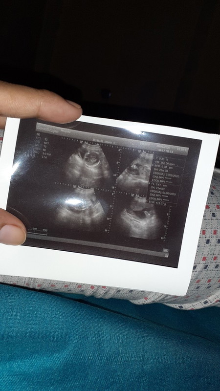 usg Alhmdulilah seneng bngt bun awal nya kaget tkt knph"gtu