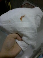 lungad na may kasamang dugo May nakaexperience po ba sa anak