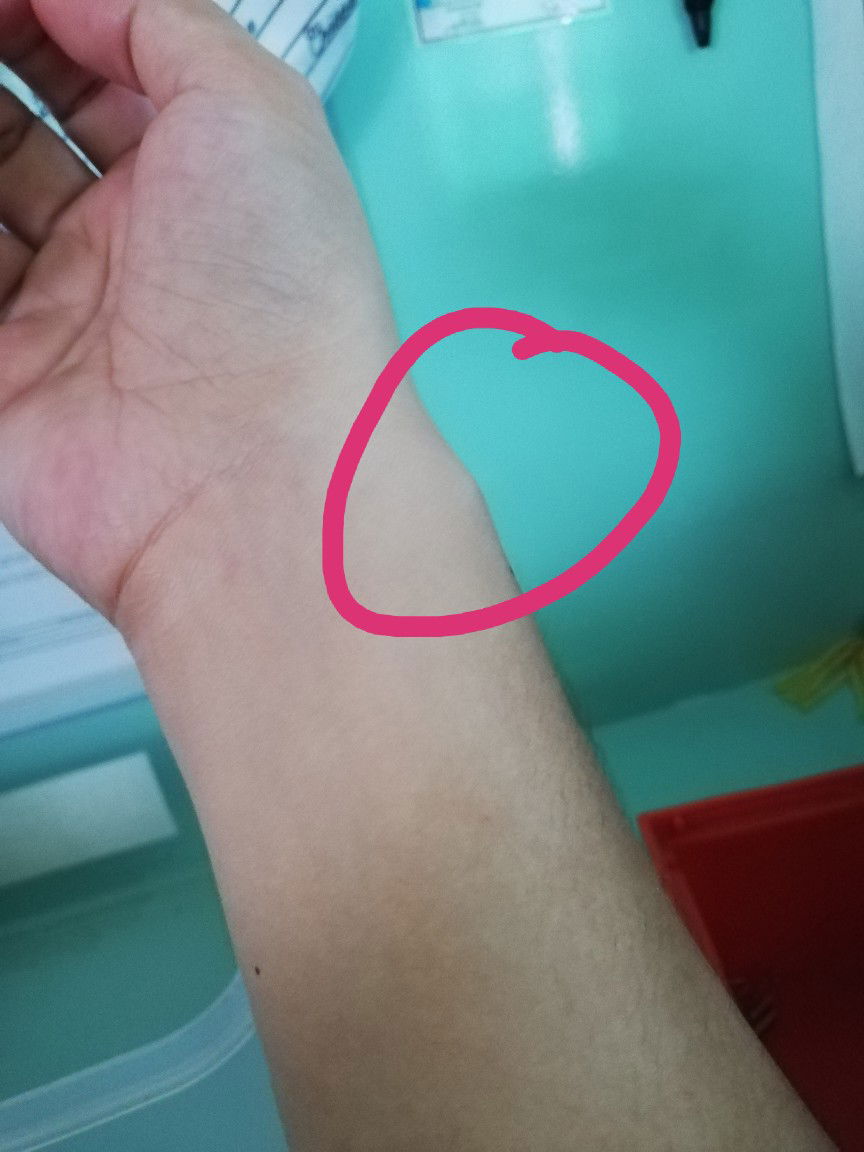 Bukol Na Maliit Mga sis tanong ko lang po nagkaganito din ba