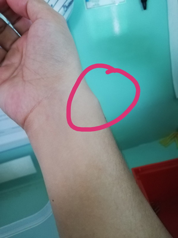 Bukol Na Maliit Mga sis tanong ko lang po nagkaganito din ba