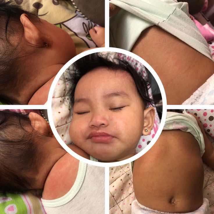 Bungang araw? Tigdas? Tigdas hangin? ? Mga mommy help naman