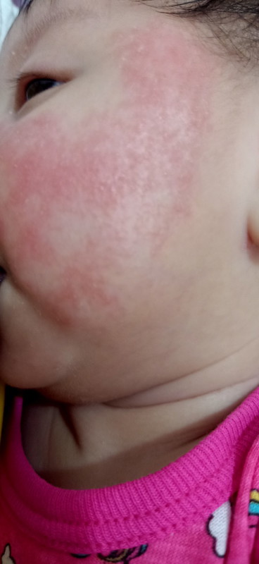 Rashes ni baby Hi mamsh, ask ko lang ano mga ginamot nyo sa