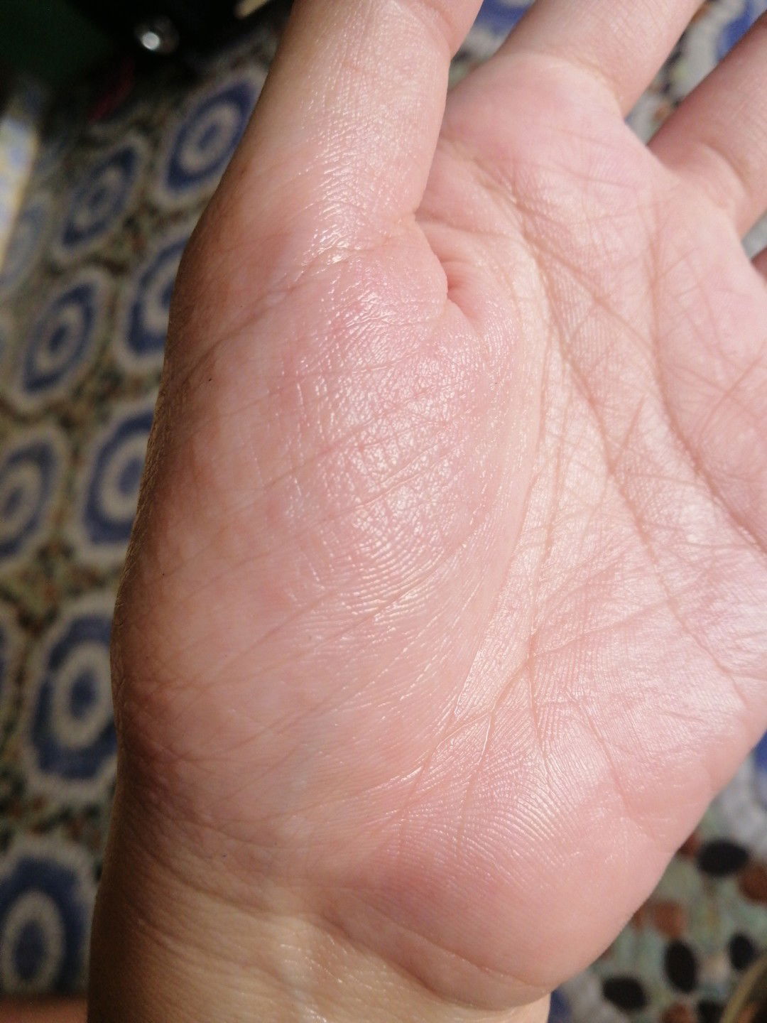 butlig sa kamay Hi po sobrang kati po kase ng mga palad ng k