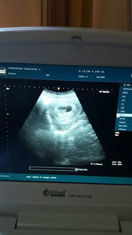 usg Bun ini hsil usg saya hari selasa ..uk 8 week normalkh b