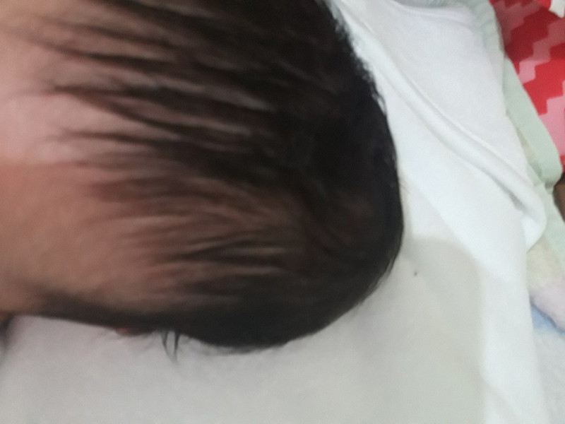 bukol sa ulo ni baby Mga mommy normal lang ba ung bukol na m