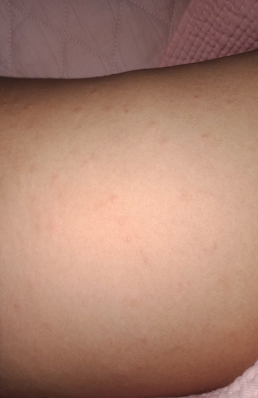 rashes sa body I'm 8 months pregnant. Worried talaga ako kc