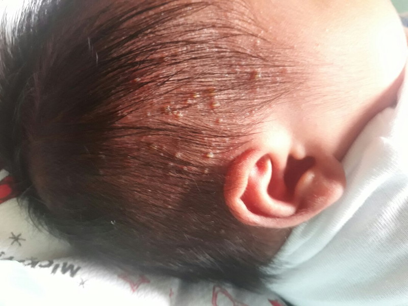 Butlig sa ulo Mga momsh pahelp naman po. Anu po kaya ito? Ma