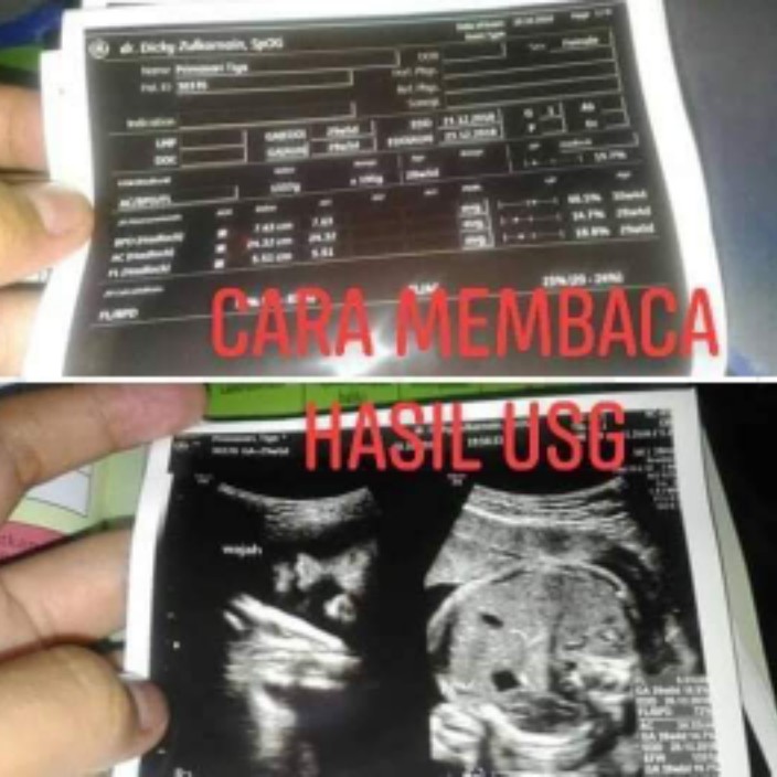 cara baca hasil USG(semoga bermanfaat) Cara membaca hasil US
