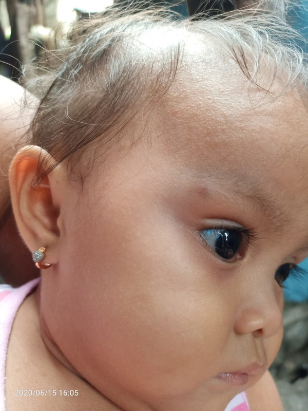 Orbital Dermoid Cyst on Babies Anyone here na merong orbital