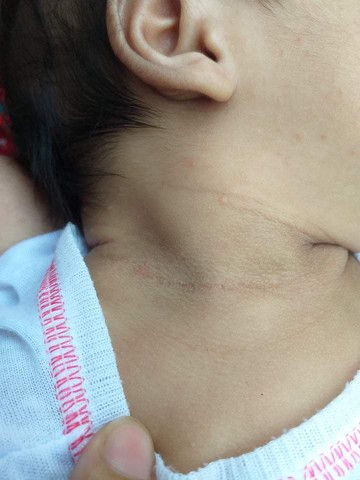 Leeg ni Baby Nangingitim leeg ni Baby or parang may libag. 1