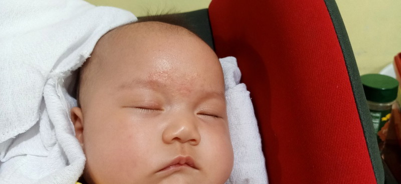 rashes Sino po nakaranas na rashes na ito sa noo nang bata p