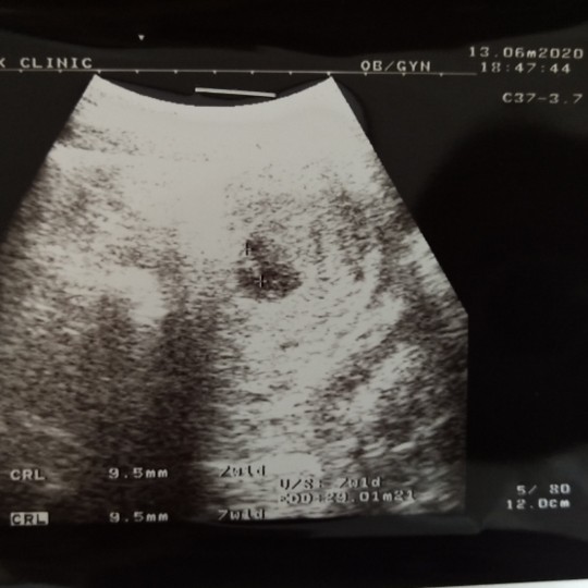 อายุครรภ์ในใบซาว7W1D อายุครรภ์ในใบซาว7W1D ในแอฟ6W5D เจอตัว