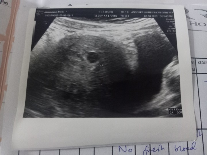 Scan baby, 9weeks Nak Tanya ibu² kat sini, Ada tak Yang pern