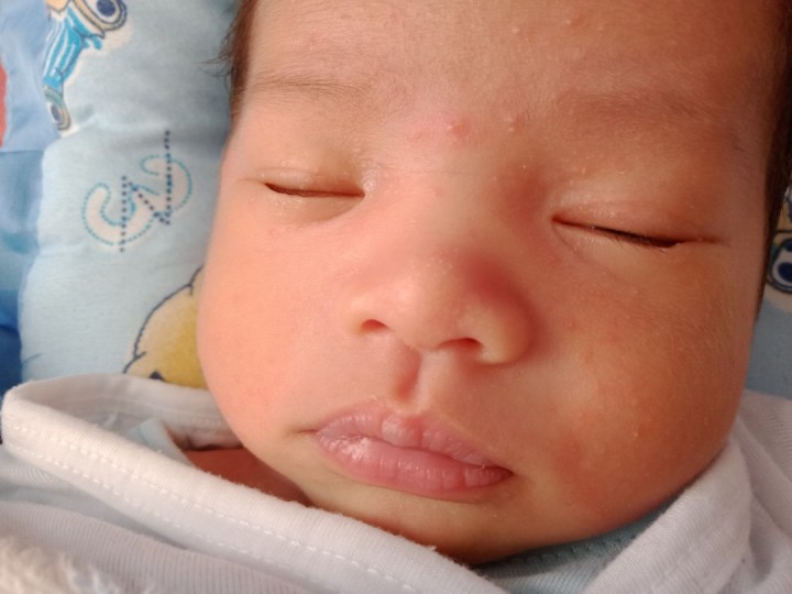 Butlig sa mukha at leeg Normal lang po ba ito sa mga newborn