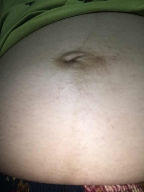 Hi mga Mommies! Normal po ba ang magkaroon ng butlig sa baby