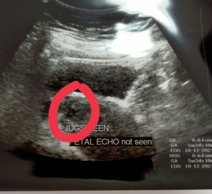 Rasa2 pregant x??? Dh lewat period 13 hari..then sakit perut