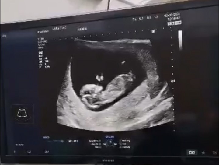 สอบถามแม่ๆค่ะ ซาวด์ตอน11w น้องตัวใหญ่ไปมั้ยคะ ตอนนี้12w5dค่ะ