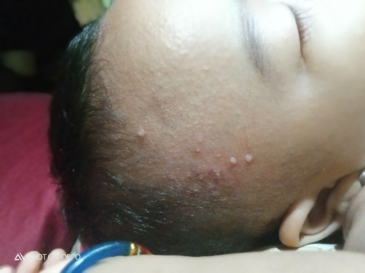 Butlig sa ulo ni baby Hi po mga mommy ask ko lang kung alam