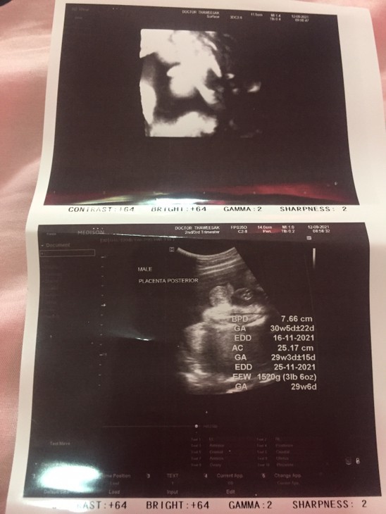 กำหนดคลอด25พ.ยค่ะ ท้องได้29w3dแล้วค่ะมีวิธีบำรุงลูกในท้องให้