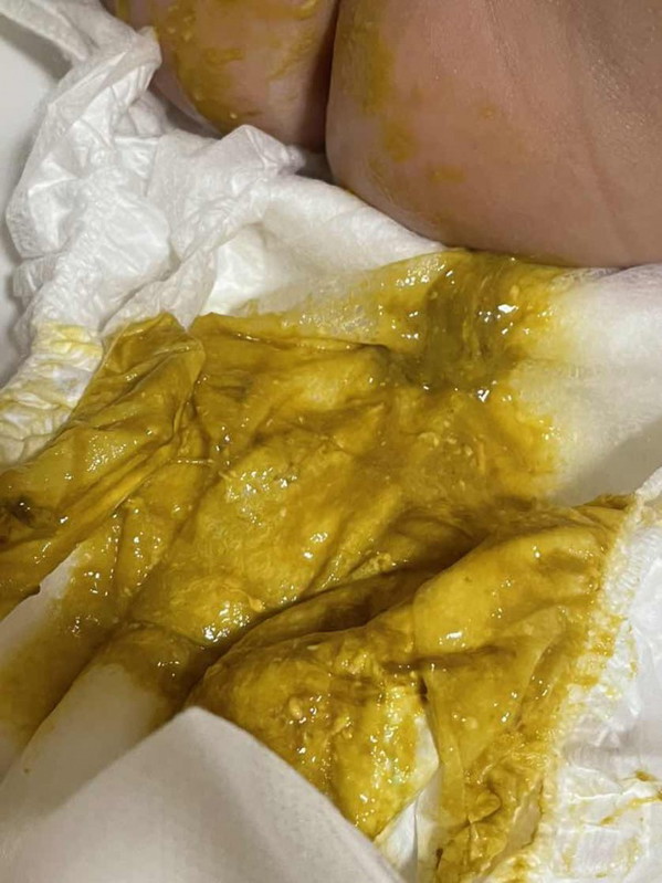 Breast milk poop or diarrhoea? Hi mommies, my 5 month old ba