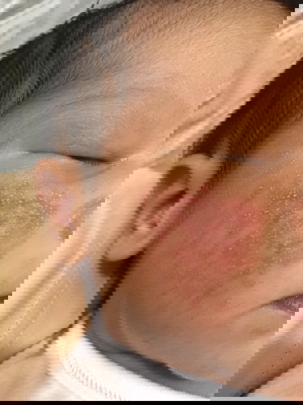 Rashes New Born Pa help naman po kasi nag ka rashes si LO, 1