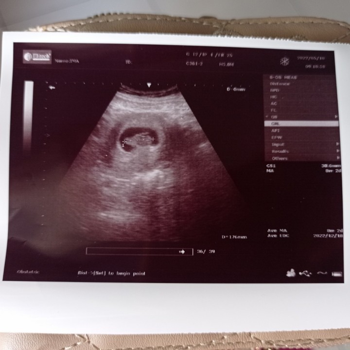 Hasil usia kehamilan sesuai usg Bunda... Barusan USG usia ke