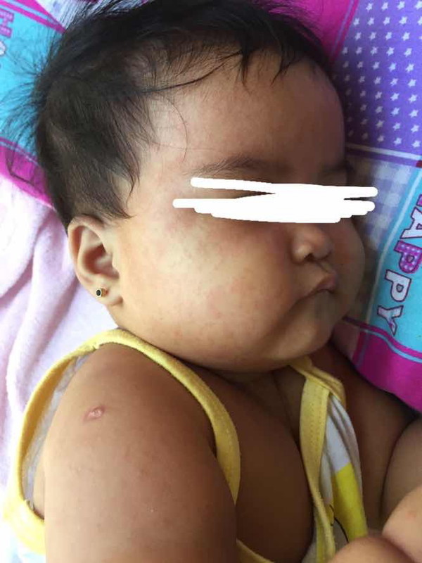 singaw ng lagnat hello may mga mommies ba dito na nagkaroon