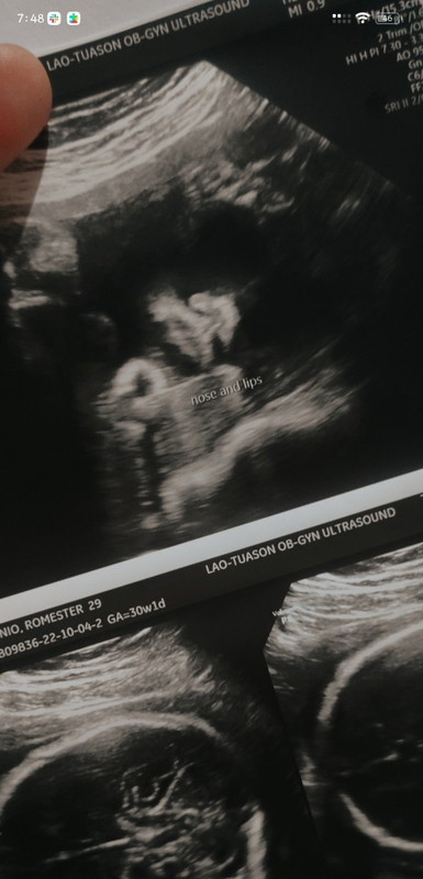 Congenital Anomaly Scan Sino po nag pa CAS sainyo? Nag pa CA