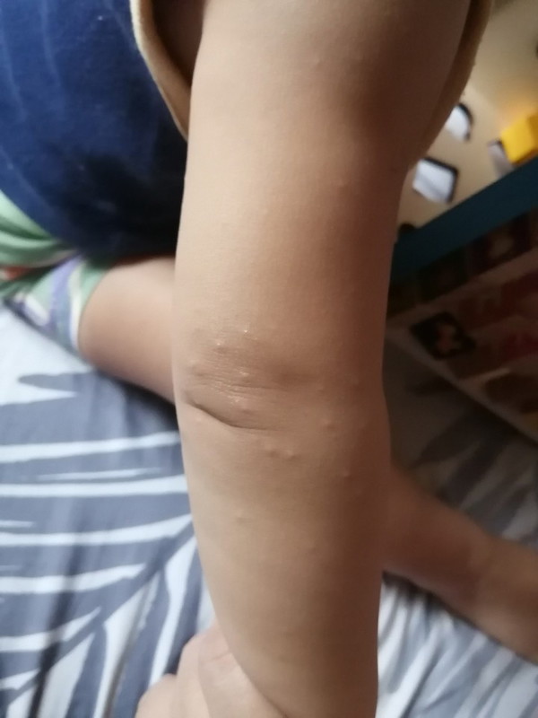 Butlig na dumadami Hello mga mie ano po kaya itong butlig bu