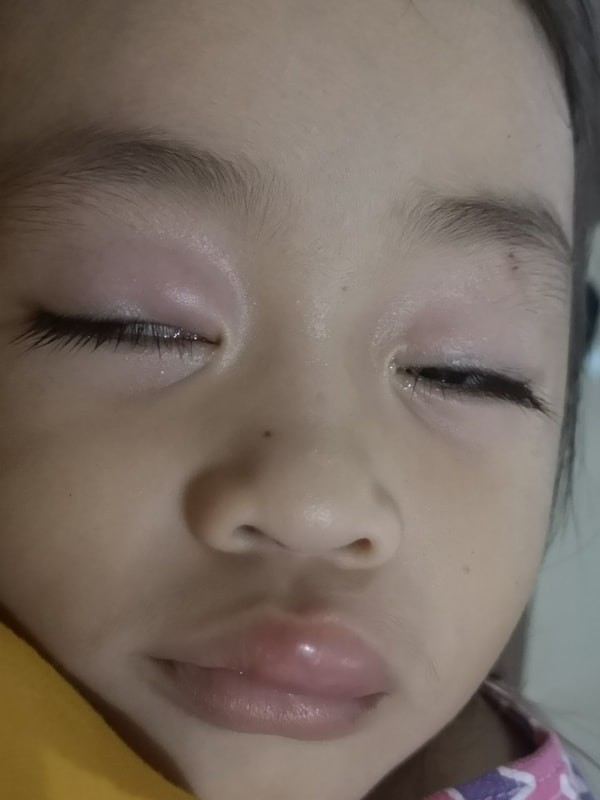 Anong Dapat Na Gawin Pamamaga Ng Labi At Mata Hello Po