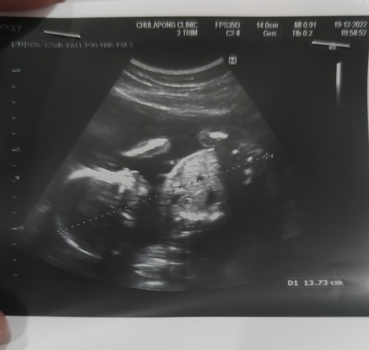 19w4d น้องมีขนาดตัวแค่ 13.73cm. ตัวเล็กไปไหมคะแม่ๆ ป้าหมอก็บ