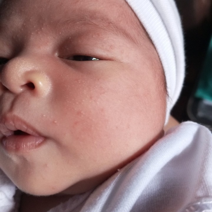 Rashes sa mukha ni baby Ano po bang magandang pantanggal ng