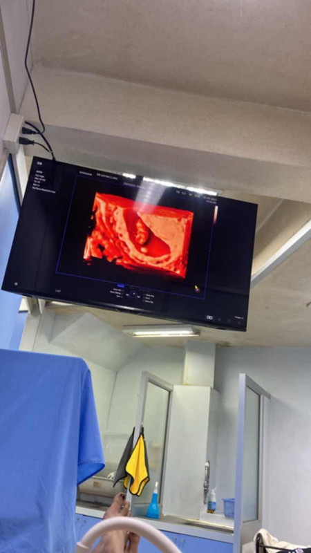 สอบถามแม่ๆคะ รู้เพศลูกในท้องตอนกี่วิคกันบ้างคะ บ้านนี้9w2dแล