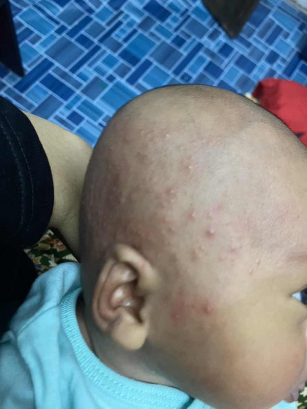 Ubat ruam baby Hi mommies, any tips atau ubat utk kurangkan
