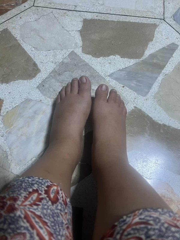 Pamamanas ng paa sa ikalimang buwan, Normal ba? Hello mga mo