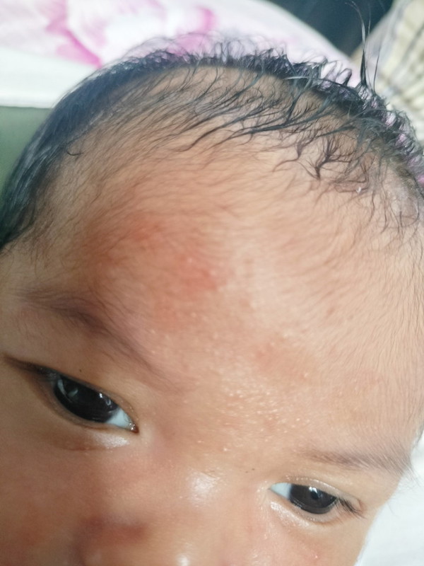 Face rash/acne? Mga mie anu po pwd ipahid o gamot sa rashes