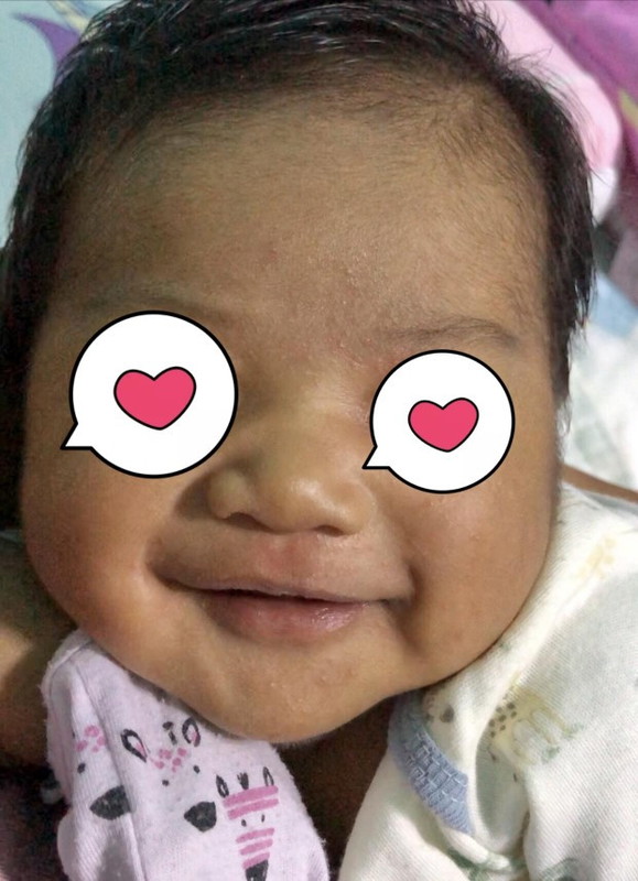 Butlig-butlig sa mukha ni baby.. Normal po ba ang butlig-but