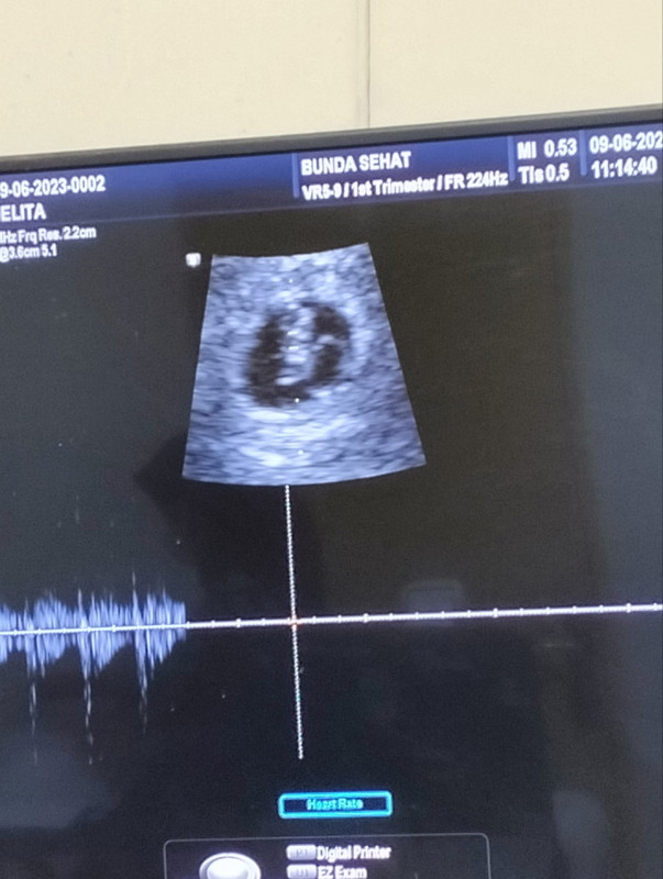 USG lemak perut tebal Waktu awal juni aku USG 2D di klinik d